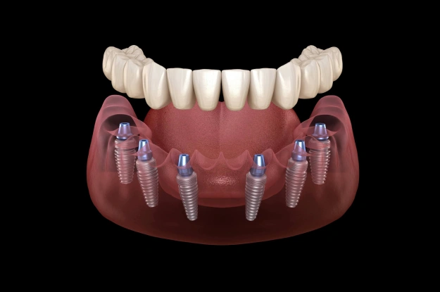 Full Mouth Implants San Antonio TX | DentRight Dental San Antonio