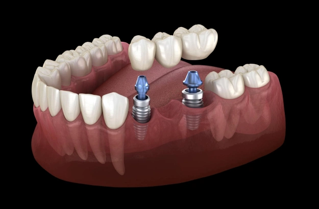 Single Tooth Implants & Bridges San Antonio TX | DentRight Dental San ...